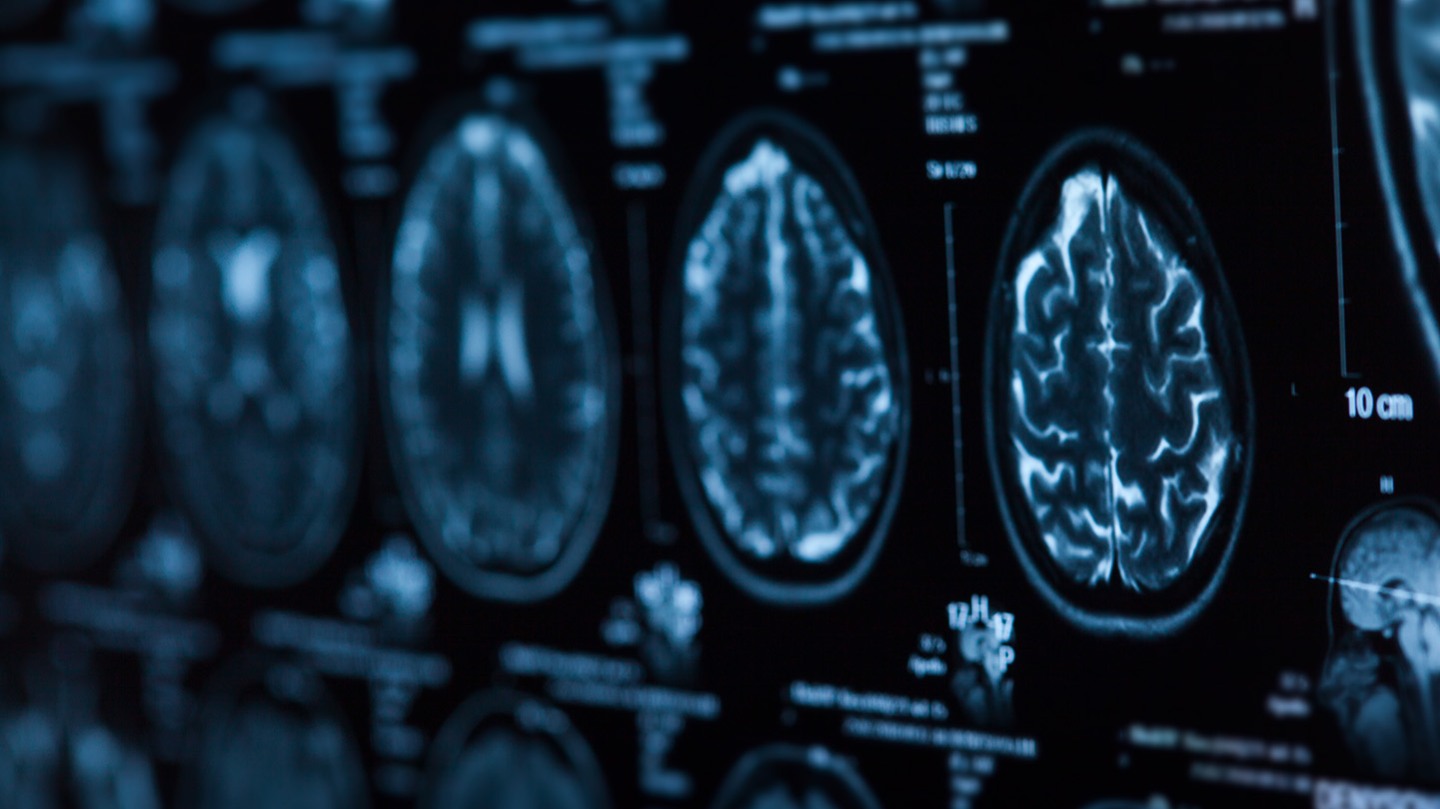 Neurointerventional Radiology | Radiology | Medical School | Brown ...